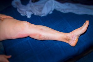 Flebite alla gamba: guida completa a sintomi, cause e trattamento ...